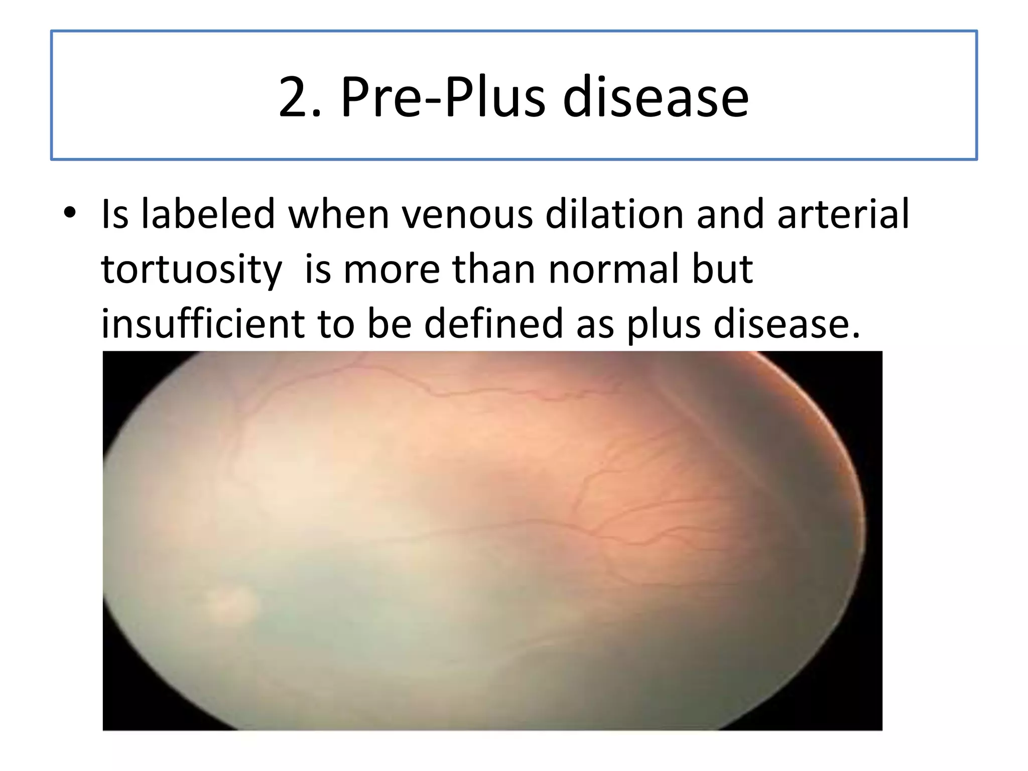 Retinopathy of Prematurity | PPTX