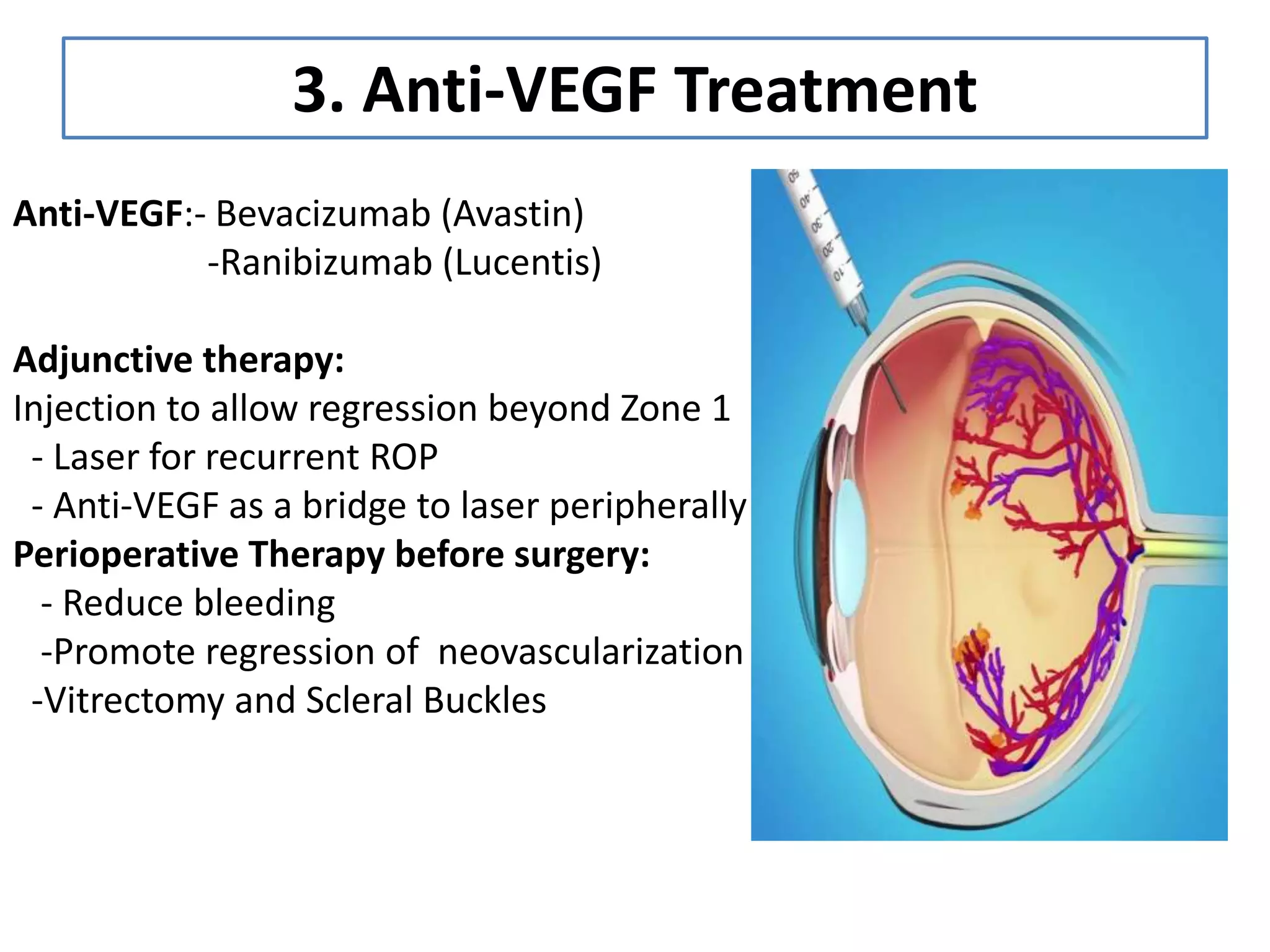 Retinopathy of Prematurity | PPTX