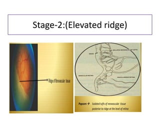 Retinopathy of Prematurity | PPTX