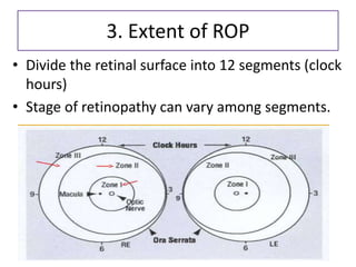 Retinopathy of Prematurity | PPTX