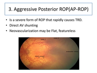 Retinopathy of Prematurity | PPTX