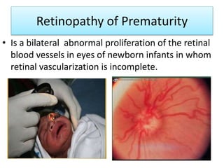 Retinopathy of Prematurity | PPTX