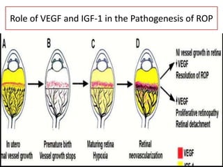 Retinopathy of Prematurity | PPTX