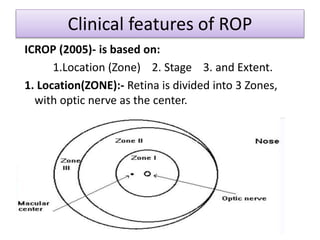 Retinopathy of Prematurity | PPTX