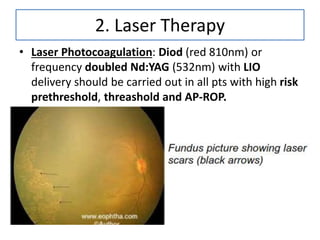 Retinopathy Of Prematurity Laser