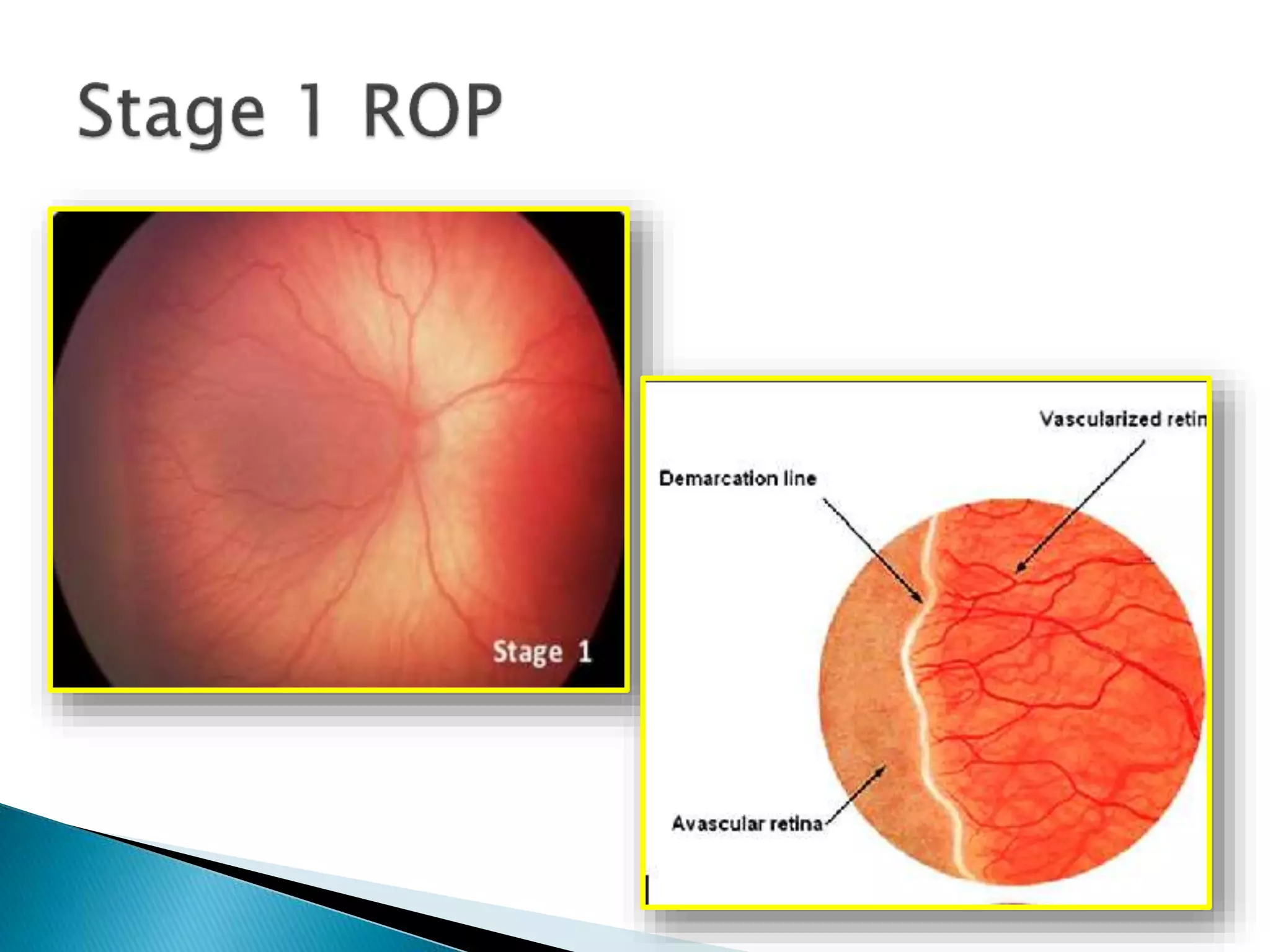 Retinopathy of prematurity.pptx