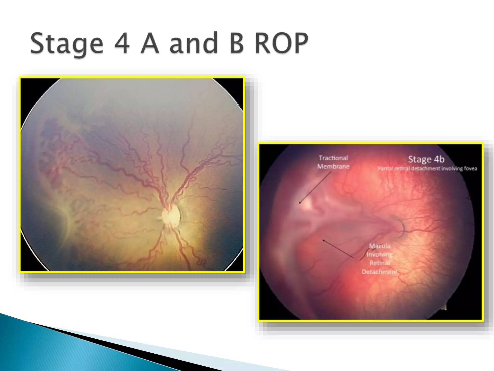 Retinopathy of prematurity.pptx