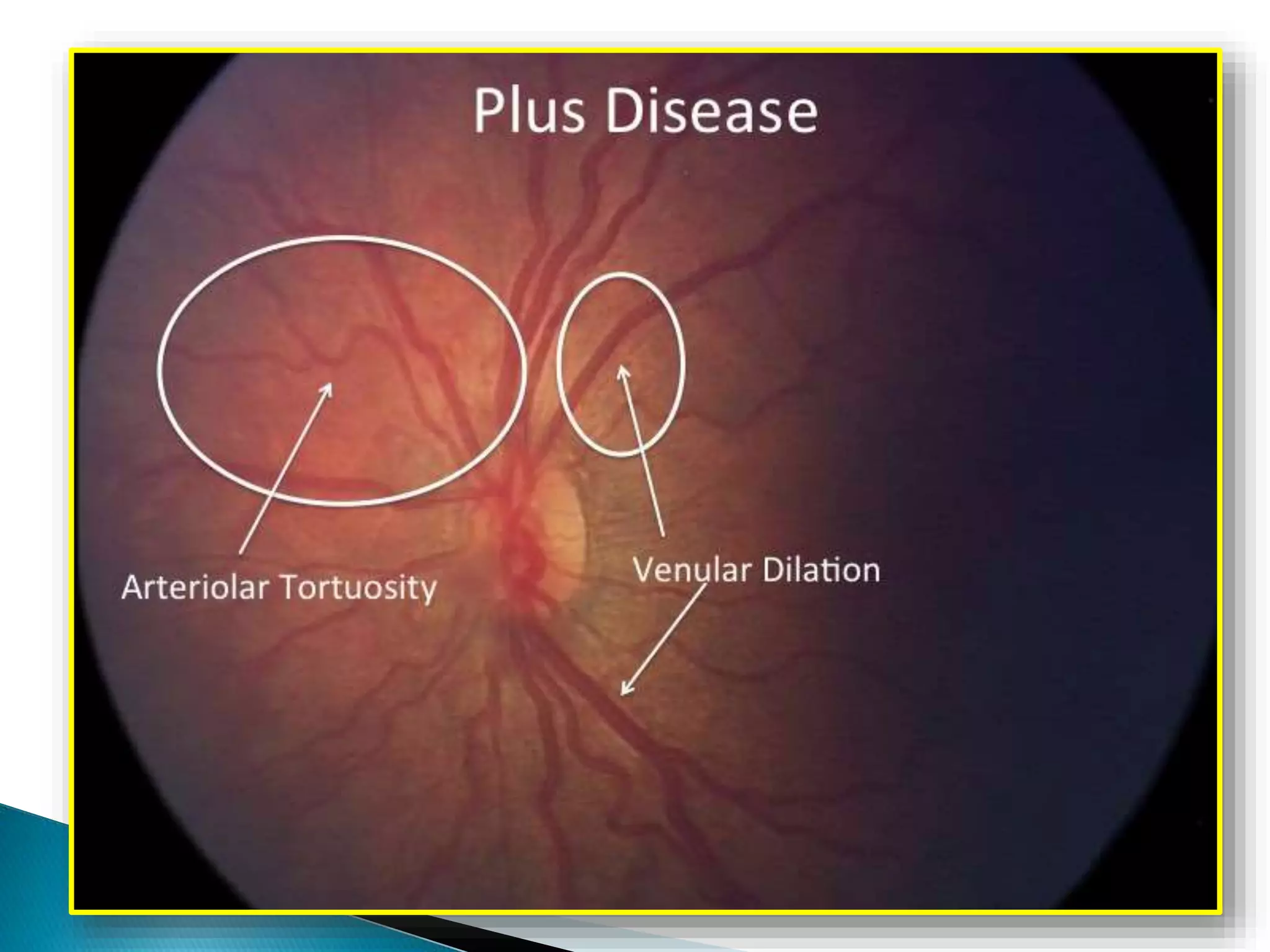 Retinopathy of prematurity.pptx