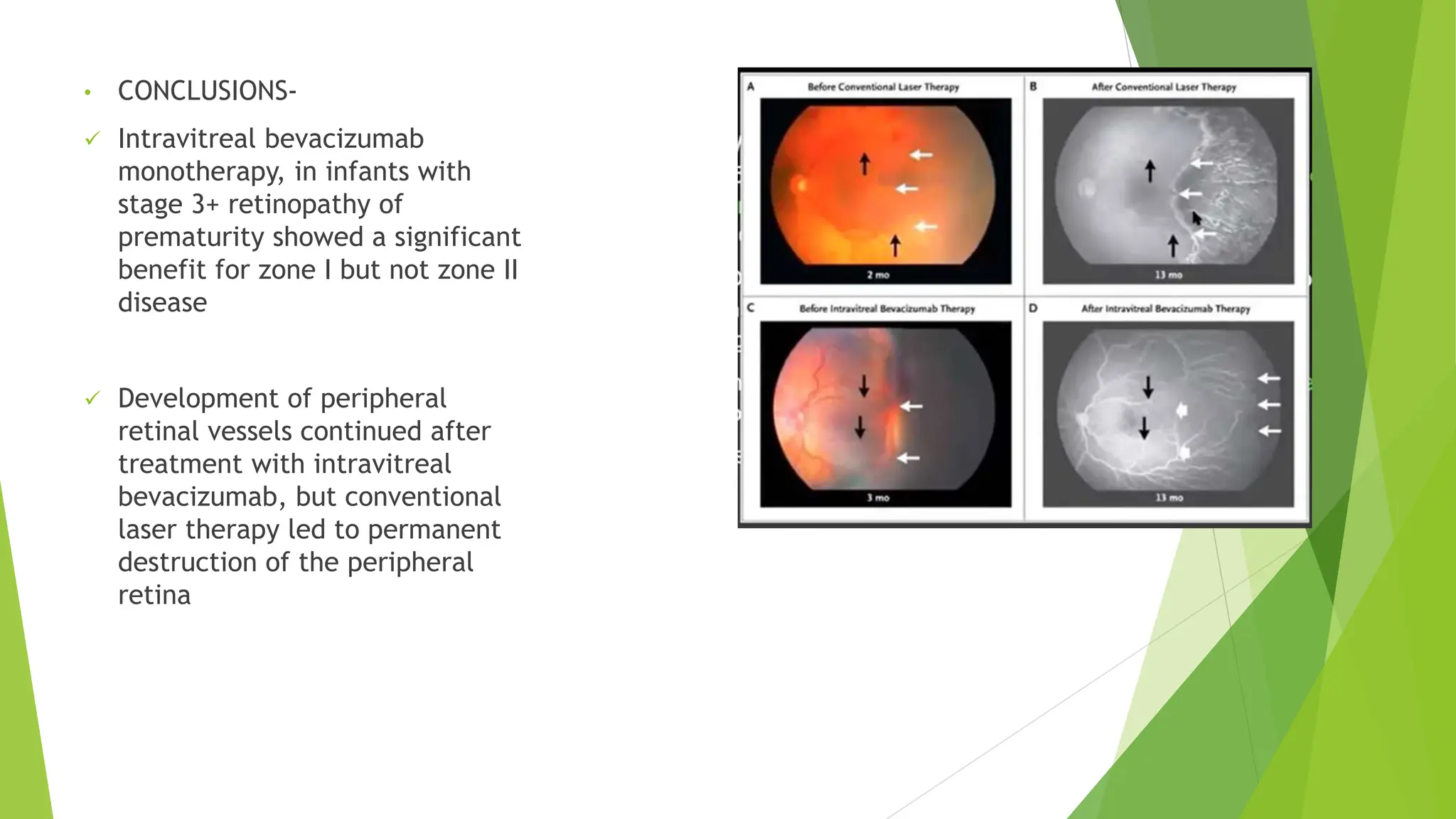 Retinopathy of Prematurity (ROP) - classification and treatments | PPTX