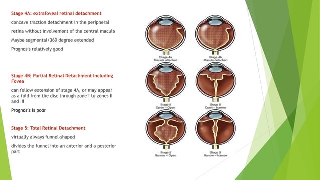 Retinopathy of Prematurity (ROP) - classification and treatments | PPTX