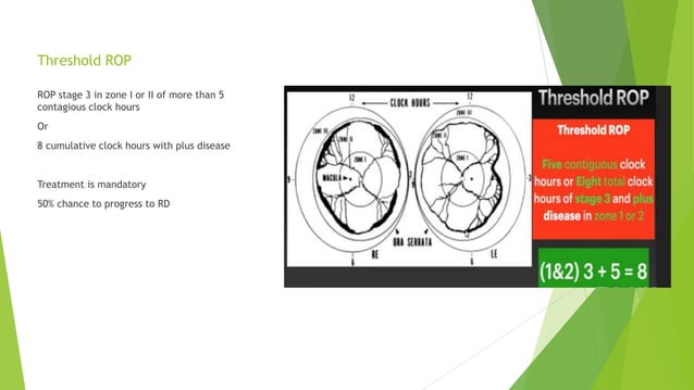 Retinopathy of Prematurity (ROP) - classification and treatments | PPTX