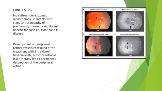Retinopathy of Prematurity (ROP) - classification and treatments | PPTX
