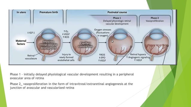 Retinopathy of Prematurity (ROP) - classification and treatments | PPTX