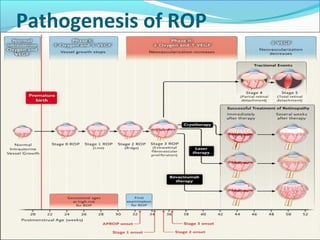 ROP current understanding and management | PPT