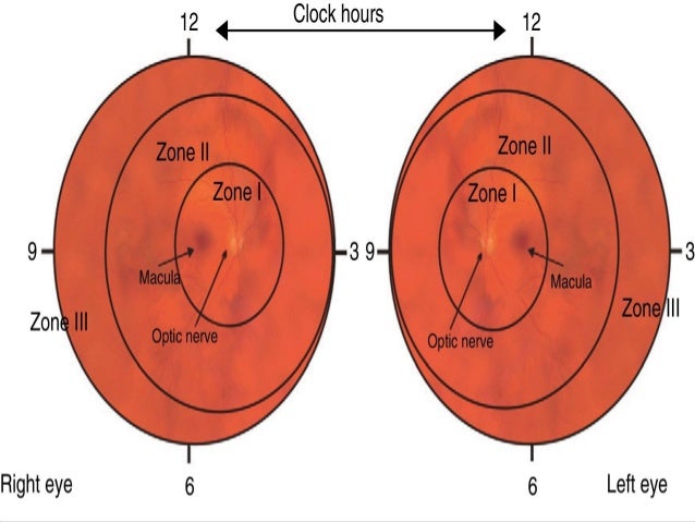 ROP current understanding and management