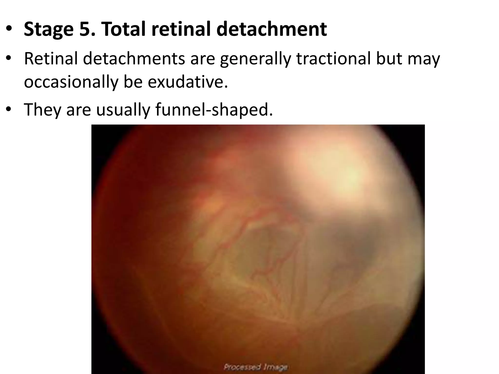 ROP - Dr Padmesh - Neonatology | PPTX
