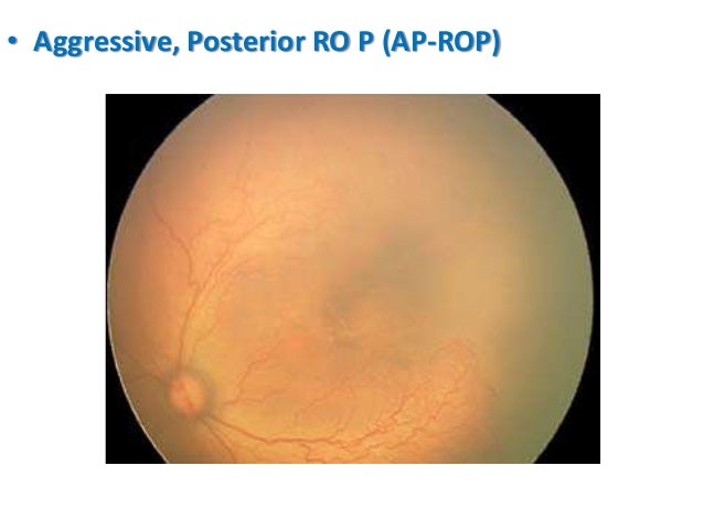 ROP - Dr Padmesh - Neonatology