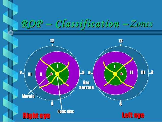Retinopathy of prematurity