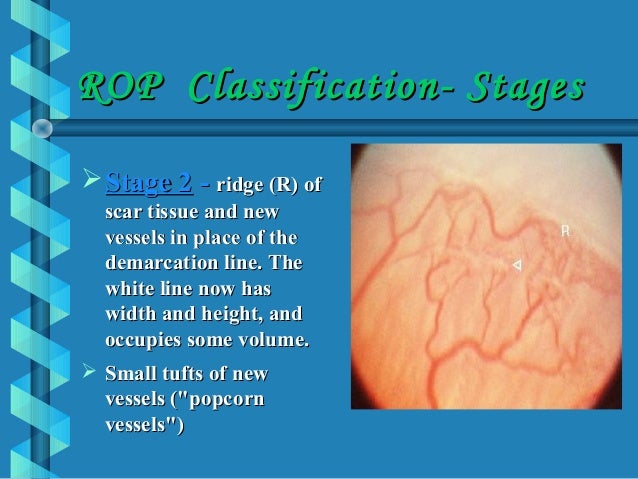 Retinopathy of prematurity