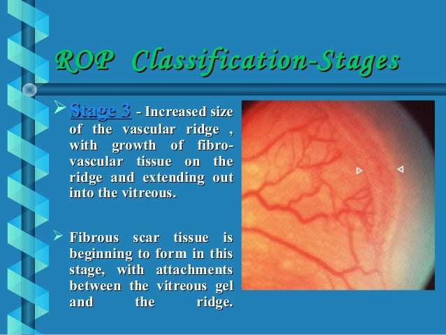 Retinopathy of prematurity