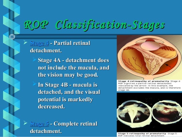Retinopathy of prematurity