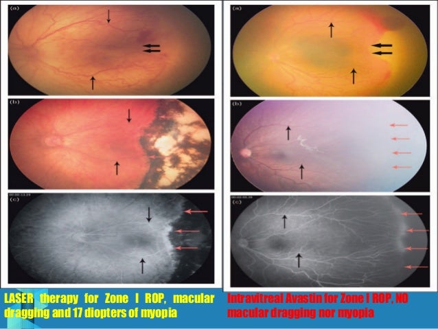 Retinopathy of prematurity