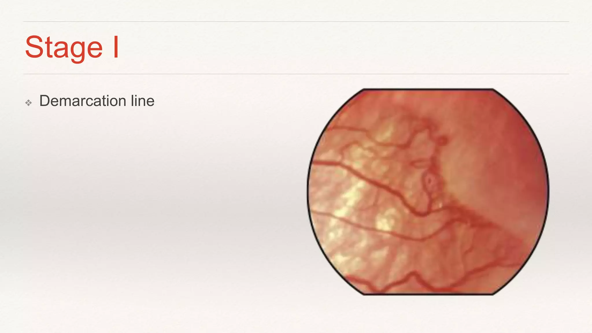 Retinopathy of Prematurity | PPTX