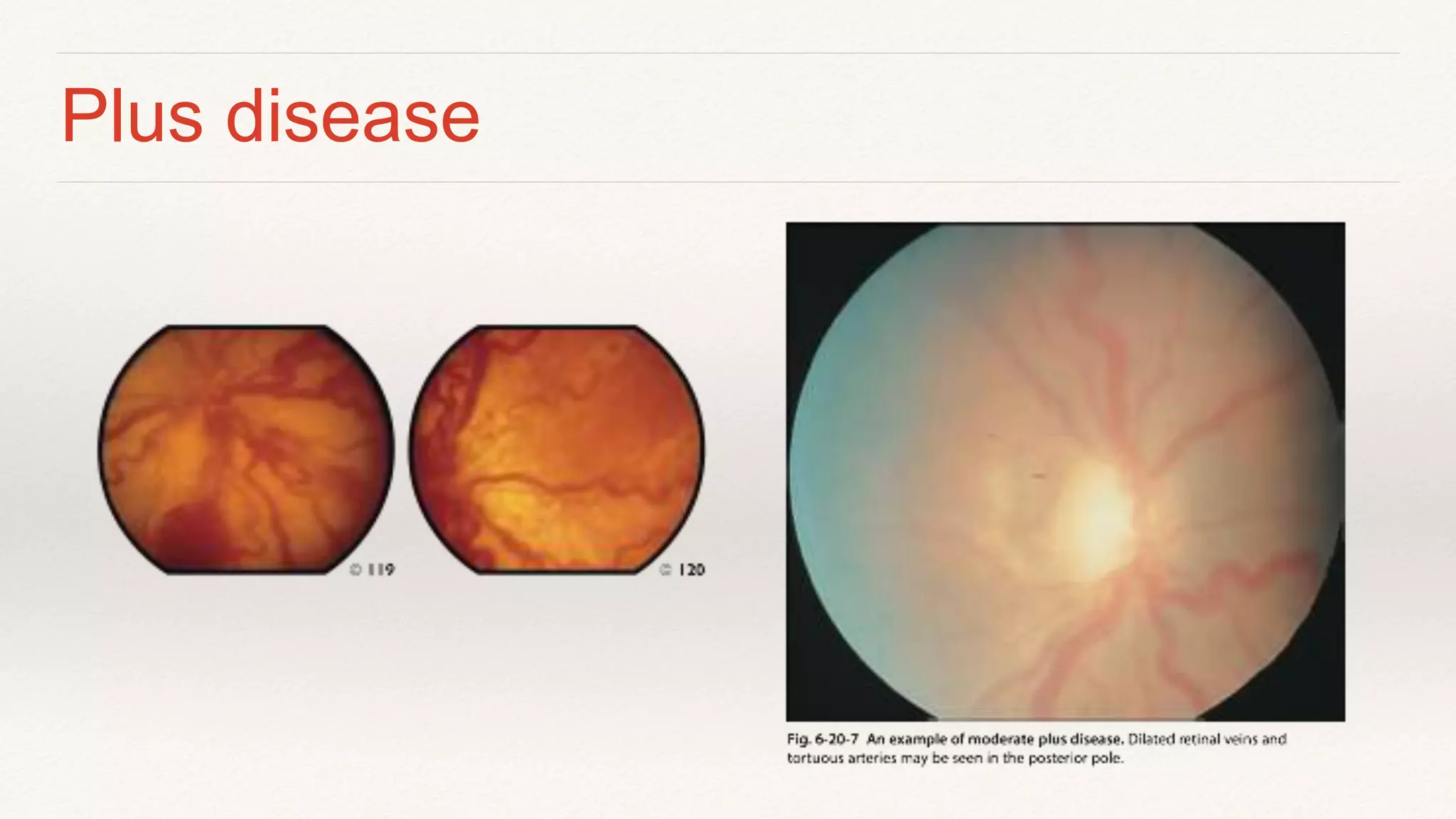 Retinopathy of Prematurity | PPTX