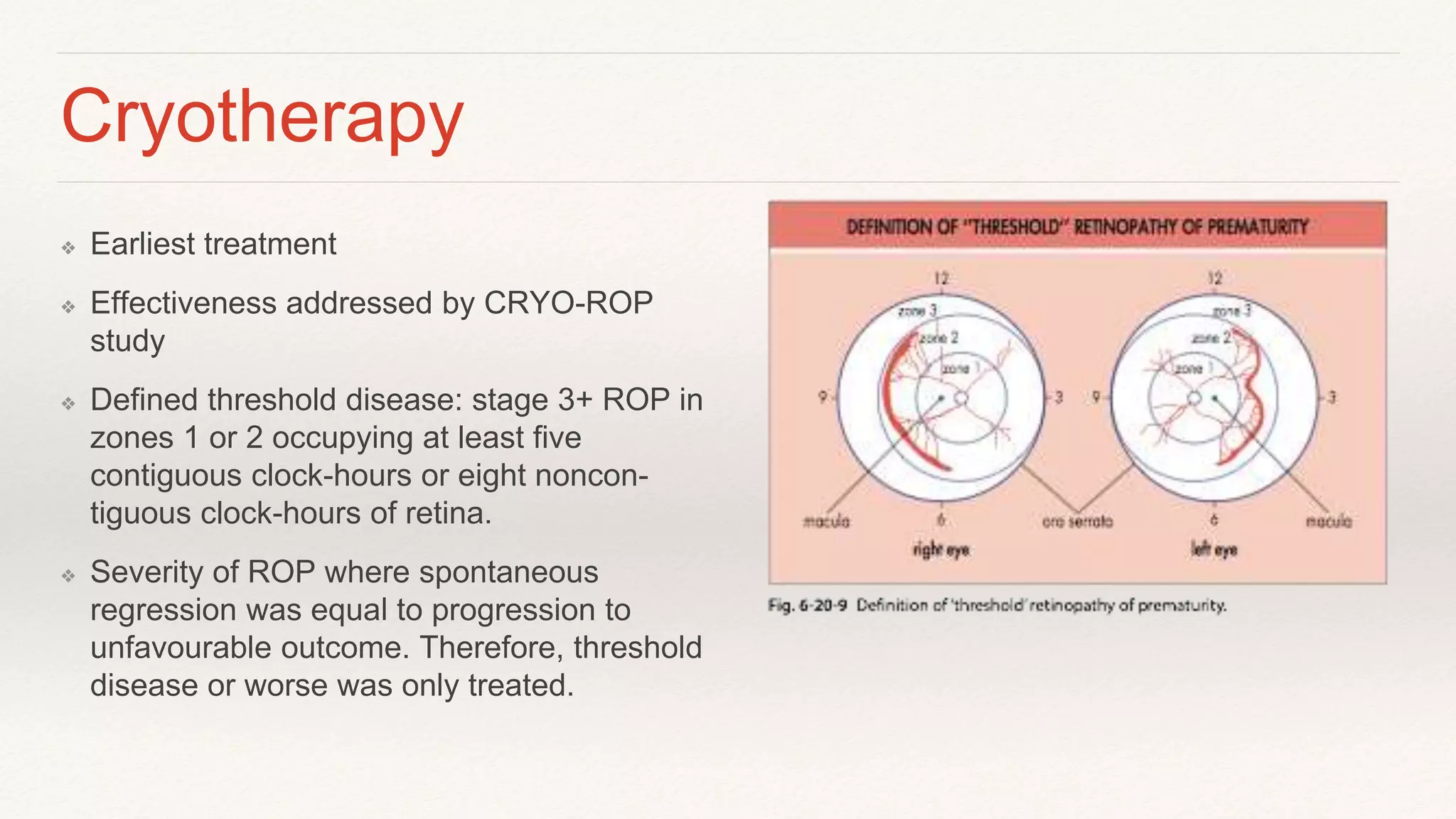 Retinopathy of Prematurity | PPTX