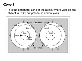 Retinopathy of Primaturity | PPT