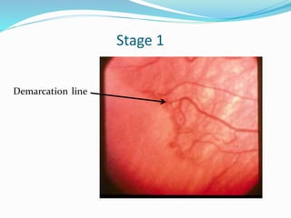 Rop screening ppt | PPTX
