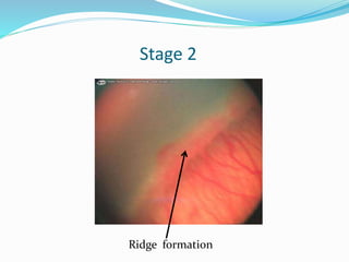 Rop screening ppt | PPTX