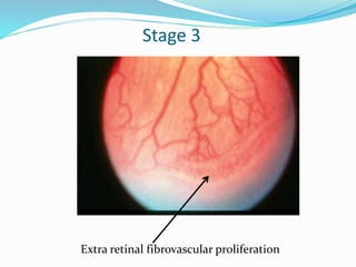 Rop screening ppt | PPTX