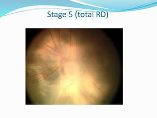 Rop screening ppt | PPTX