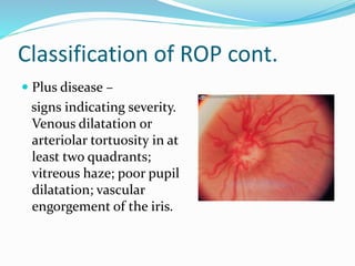 Rop screening ppt | PPTX