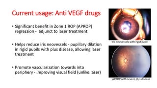 How will be treat the ROP infant .ROP TREATMENT.pdf