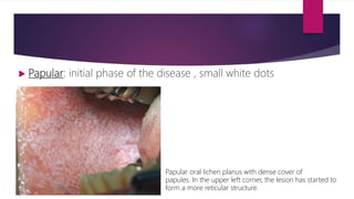 6th lecture lichen planus | PPT