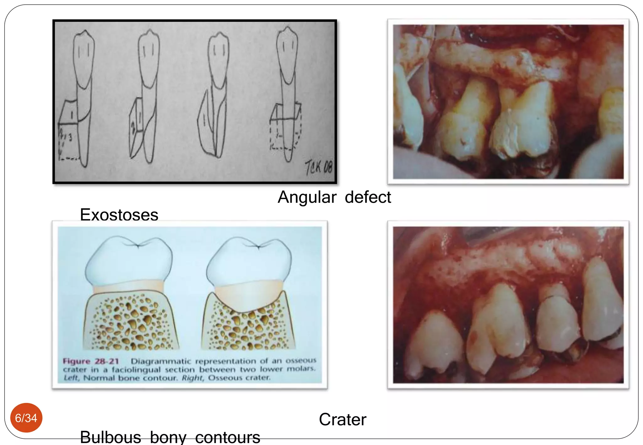 RESECTIVE OSSEOUS SURGERY | PPTX
