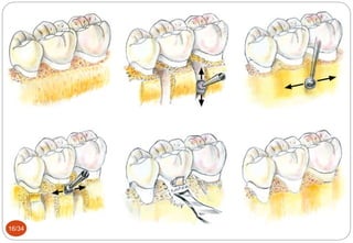 RESECTIVE OSSEOUS SURGERY | PPTX