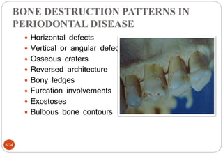 RESECTIVE OSSEOUS SURGERY | PPTX