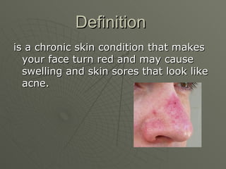 Rosacea | PPT