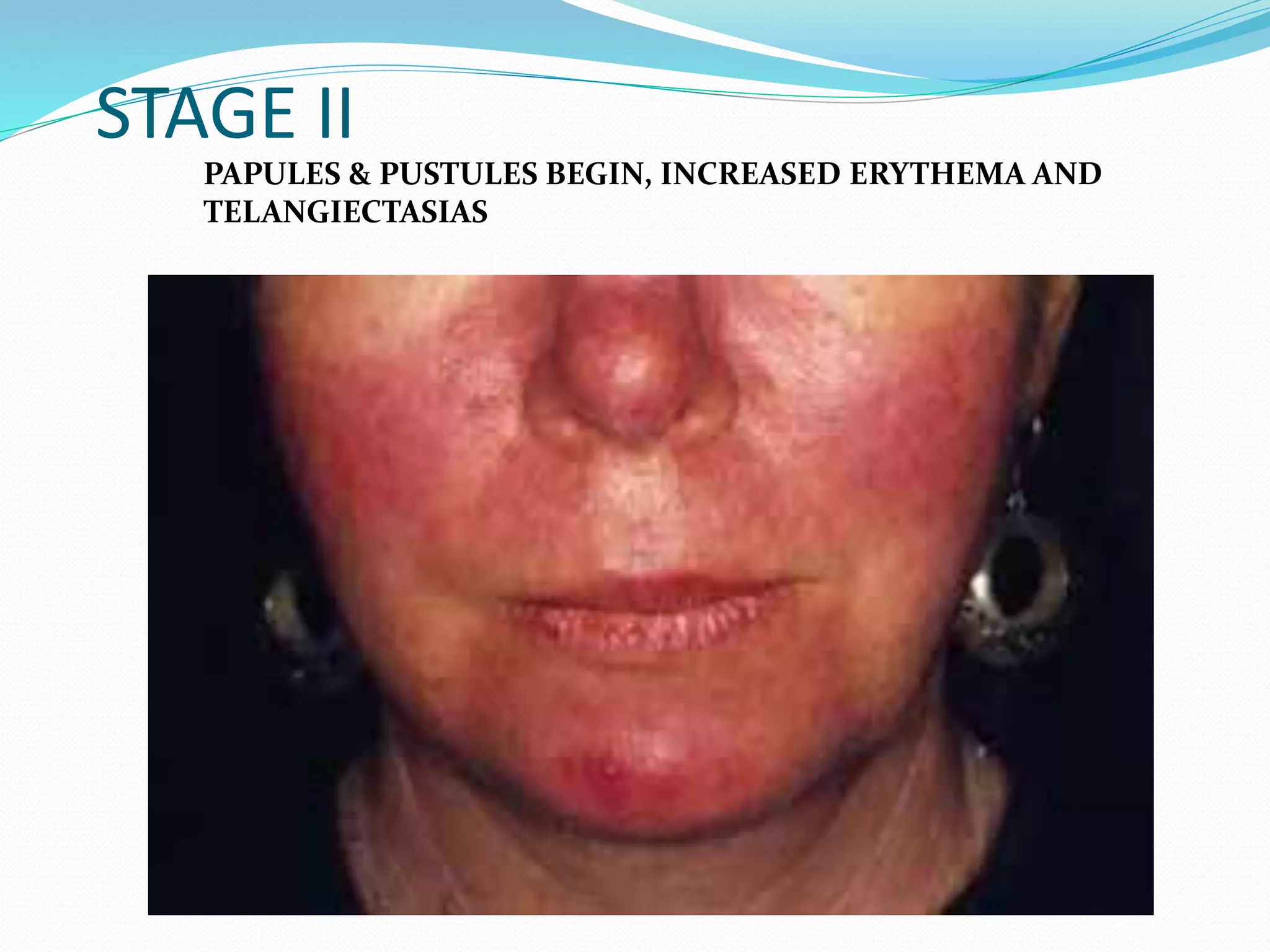 Rosacea and lymphocytic infiltration disorders | PPTX