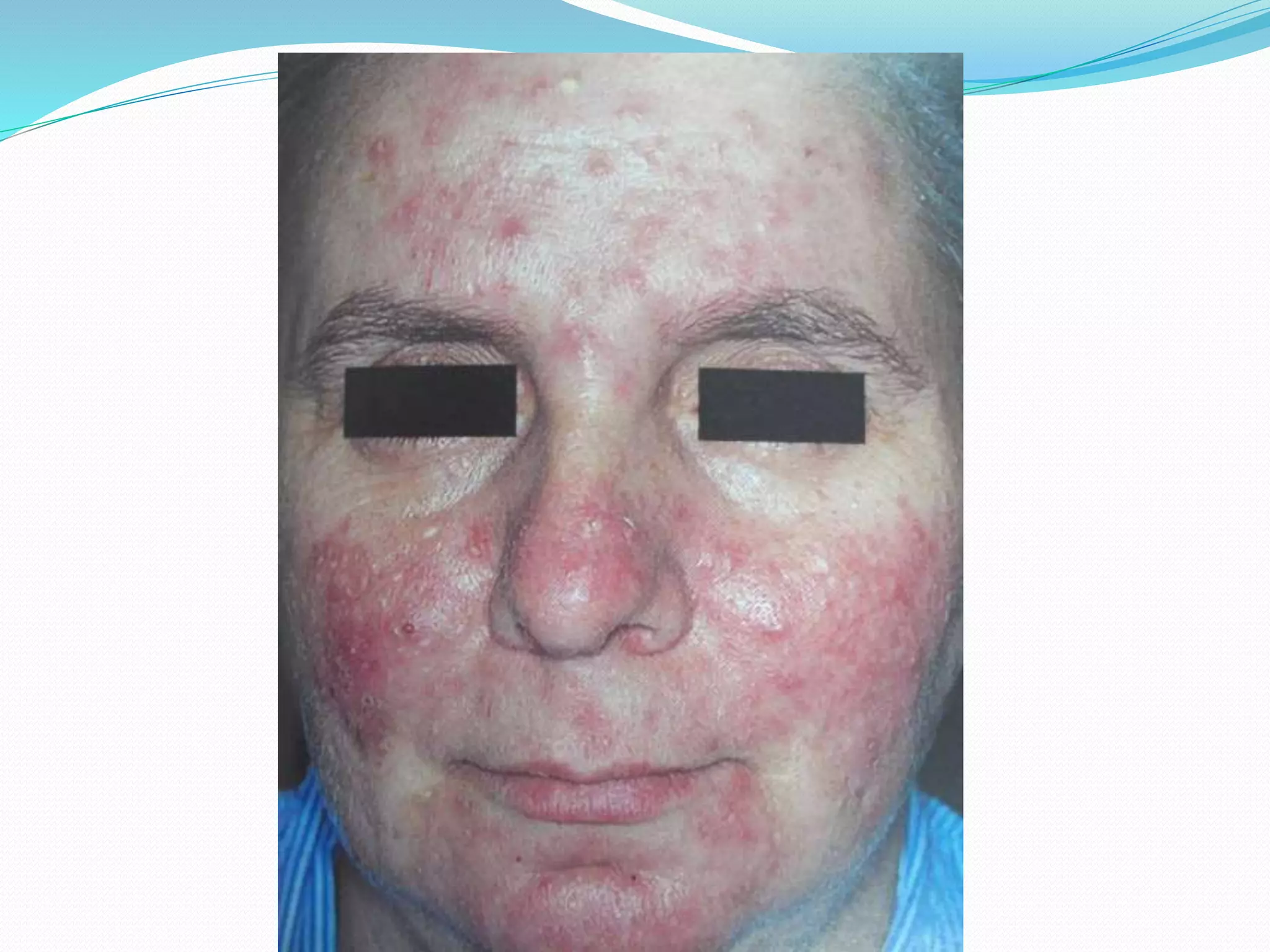Rosacea and lymphocytic infiltration disorders | PPTX