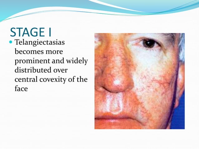 Rosacea and lymphocytic infiltration disorders | PPTX | Skin and ...