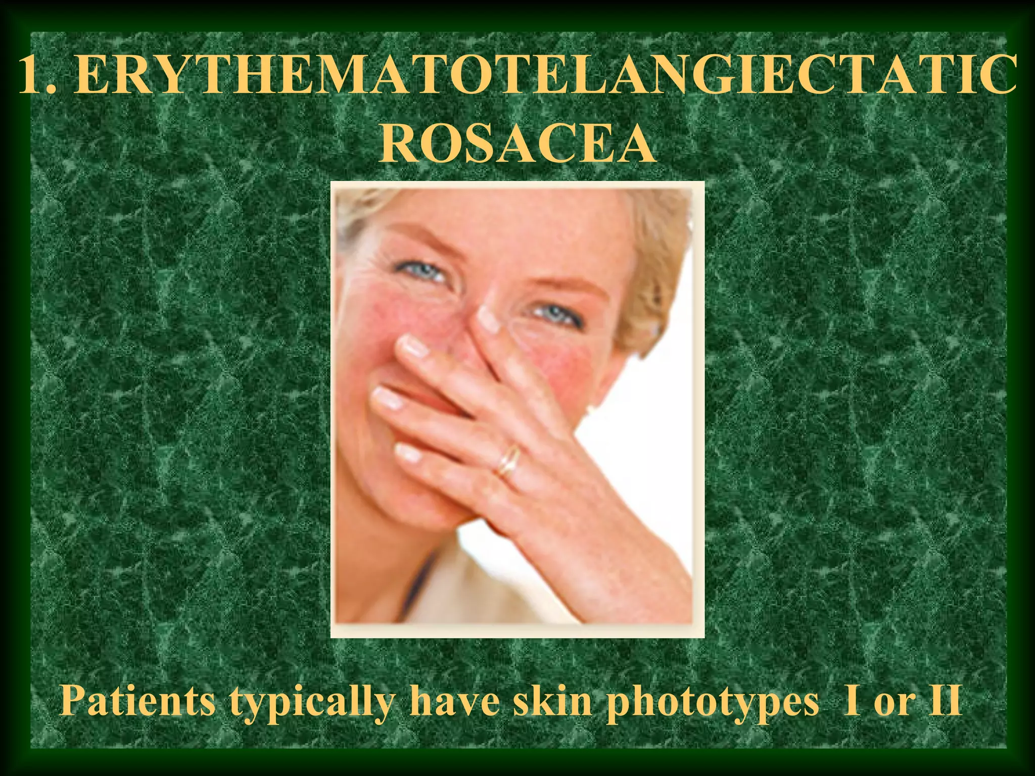 Rosacea | PPT