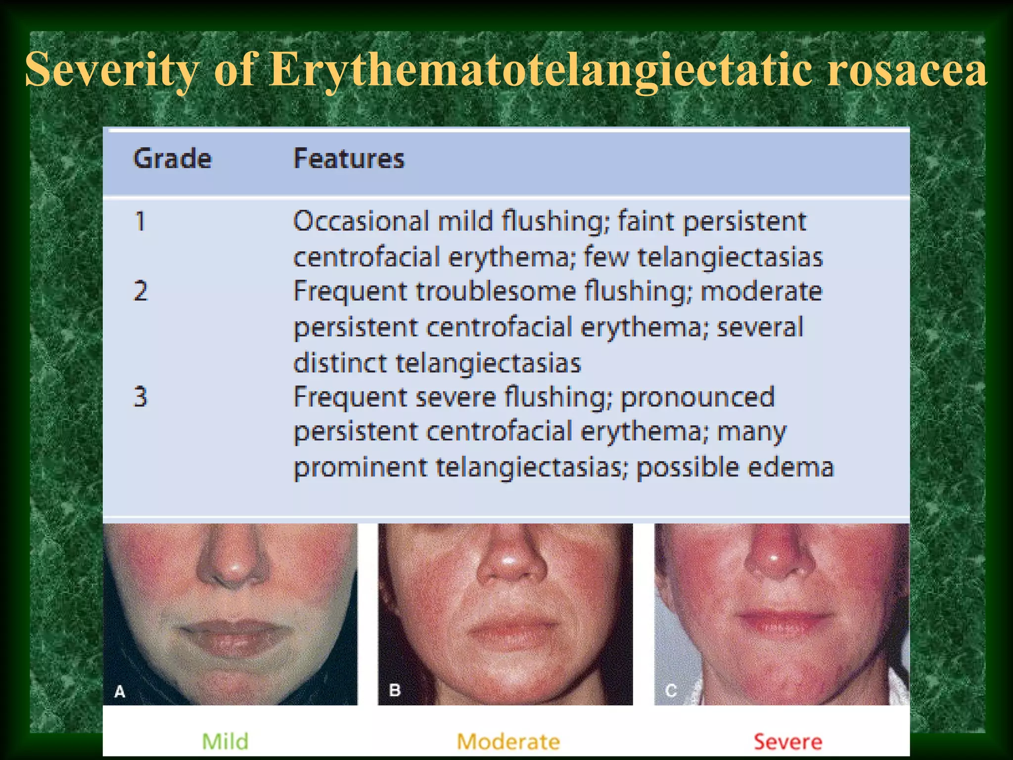 Rosacea | PPT