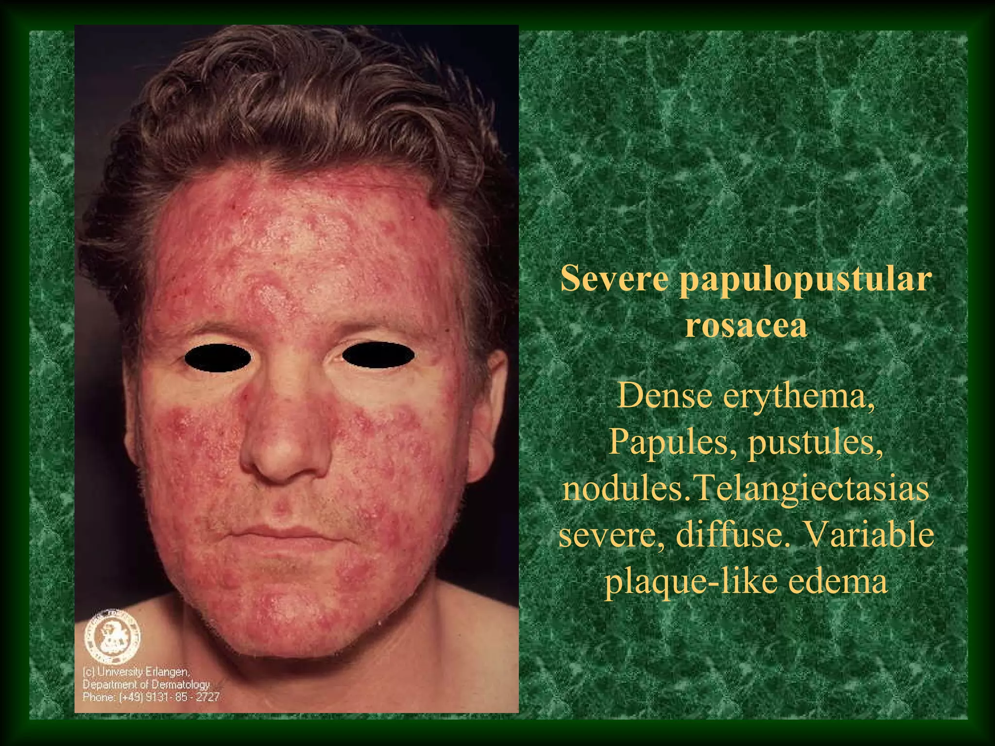 Rosacea | PPT