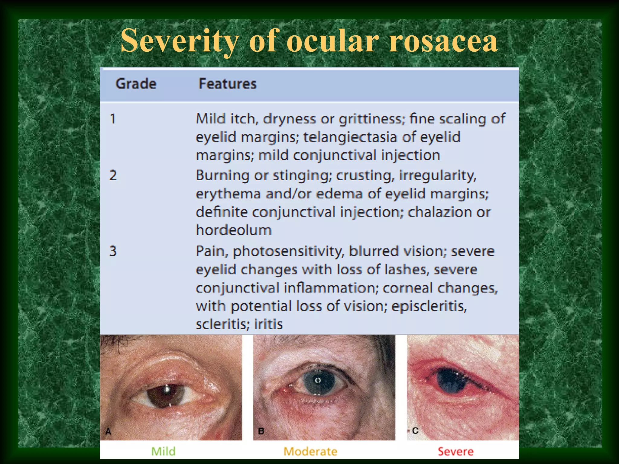 Rosacea | PPT