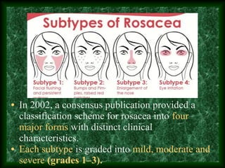 Rosacea | PPT