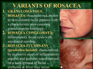 Granulomatous Rosacea Histology